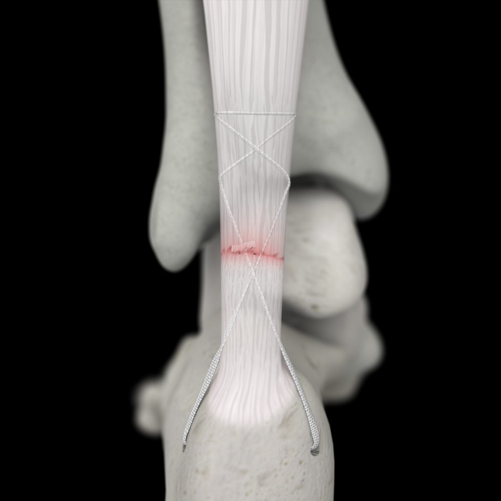 AchilloCordPLUS | Achilles Tendon Repair
