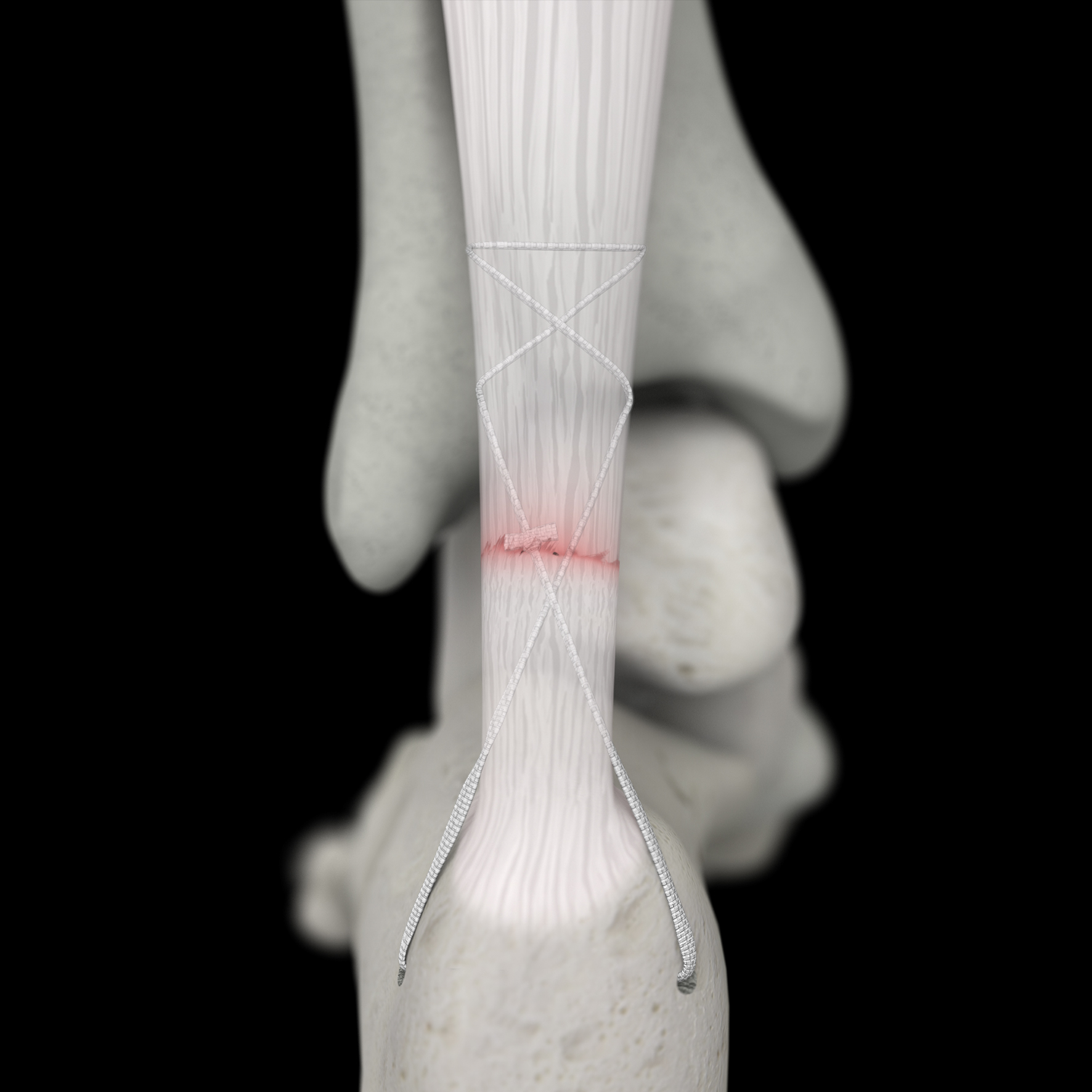 AchilloCordPLUS | Achilles Tendon Repair