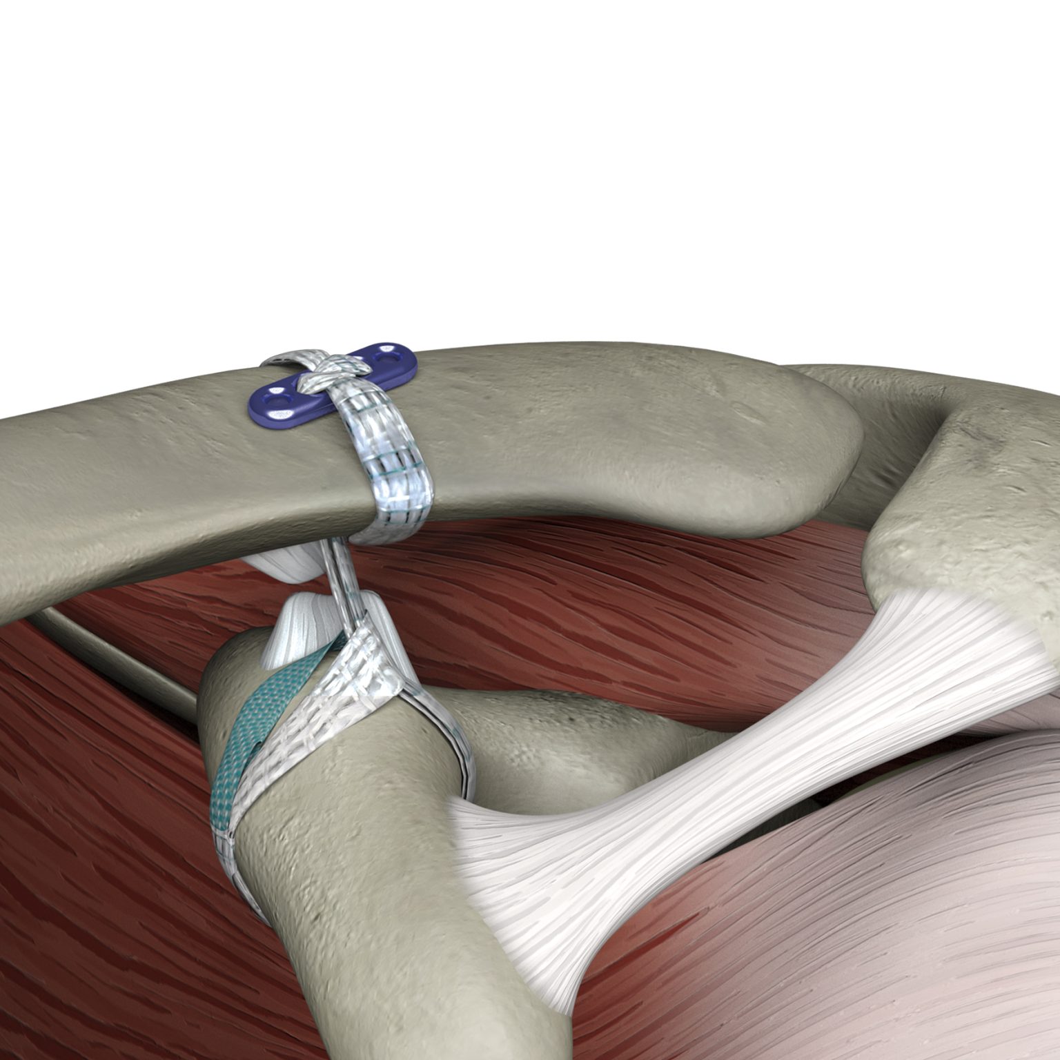 Infinity-Lock Button, Pitch-Patch by Anstem Medical in South Africa