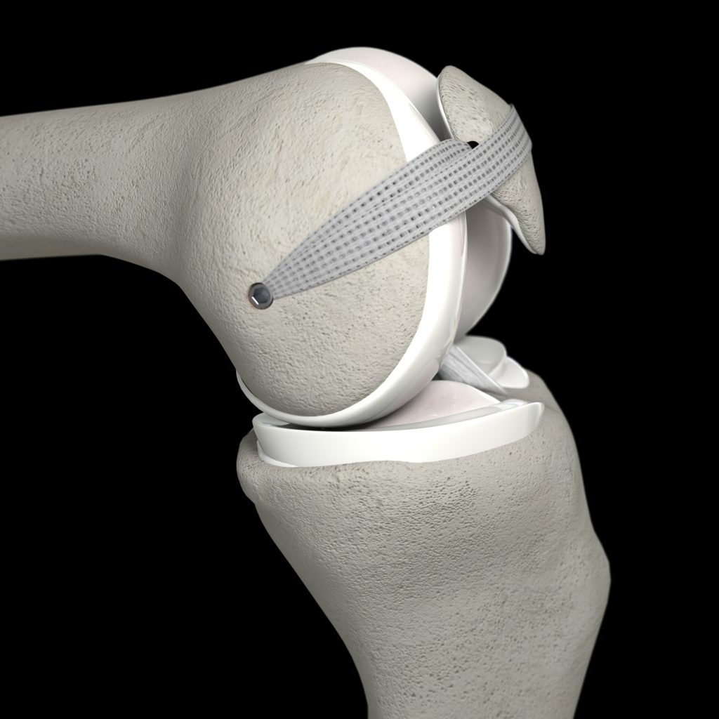 JewelACL | Anterior Cruciate Ligament Reconstruction