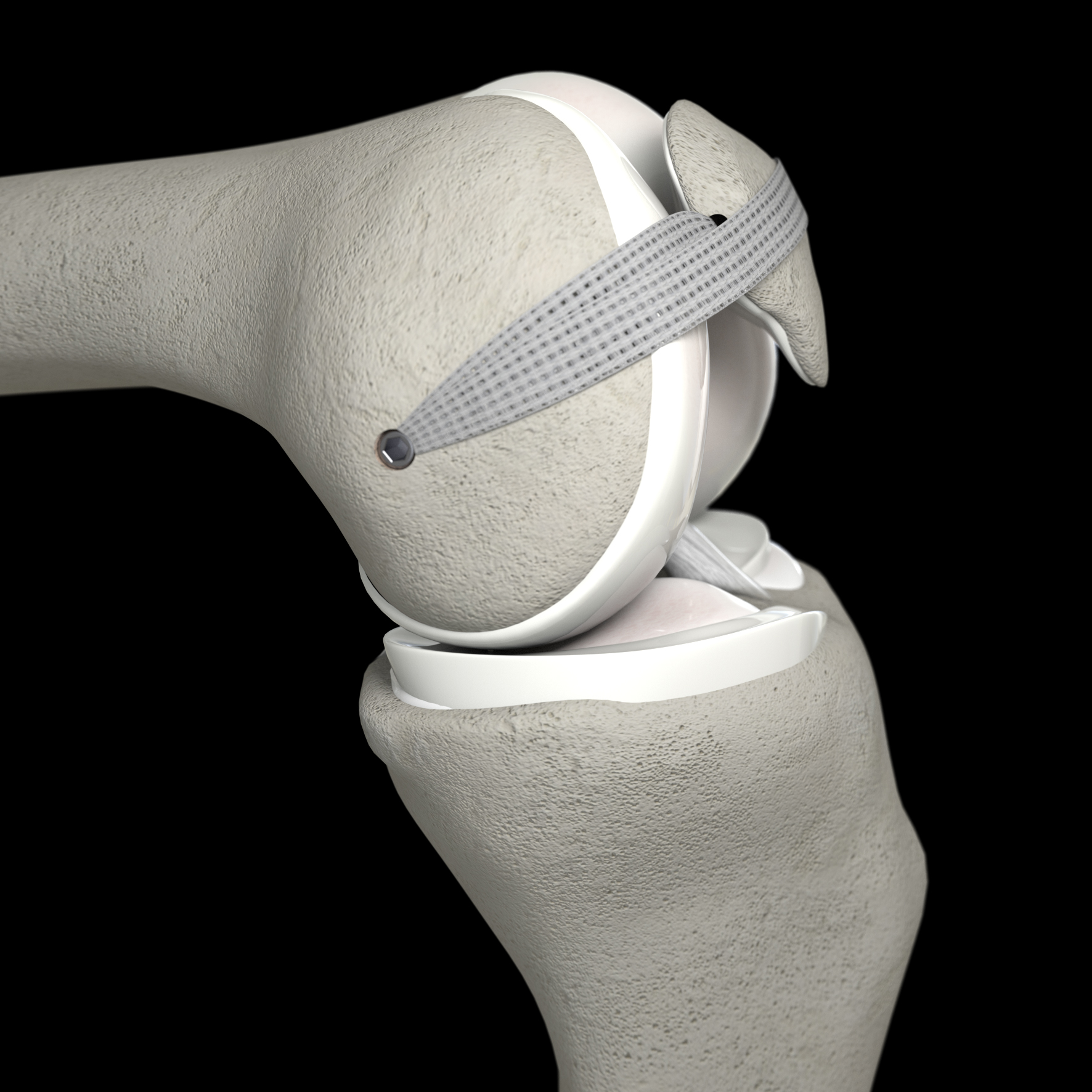 JewelACL | Anterior Cruciate Ligament Reconstruction