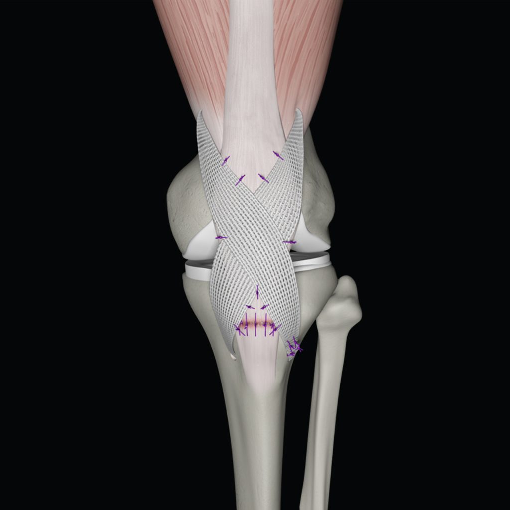 JewelACL | Anterior Cruciate Ligament Reconstruction