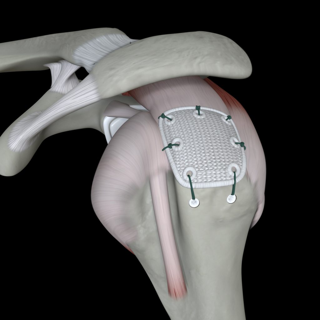 Infinity-Lock Button, Pitch-Patch by Anstem Medical in South Africa