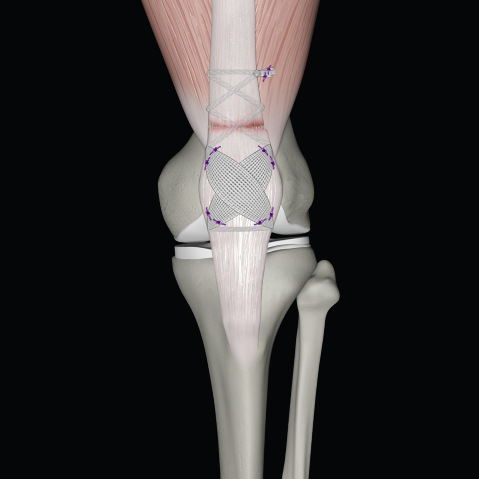 JewelACL | Anterior Cruciate Ligament Reconstruction